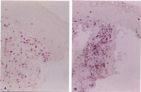 Ectocervix With Inflammation A Abundant Cd4 þ Lymphocytes Present In
