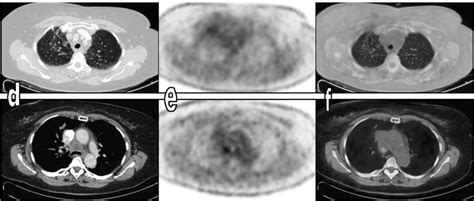 A 62 Year Old Male Patient With Pathologically Proven Metastatic Rcc Download Scientific