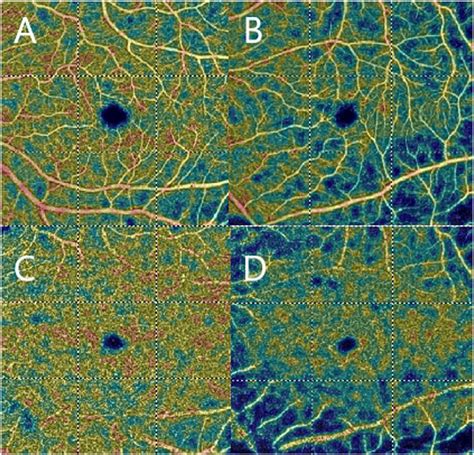 Figure OCTA Scans A HC Superficial Plexus B MfS Superficial Download Scientific Diagram