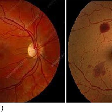 Segmented Retina Calculation Of Artery Vein Ratio Download Scientific