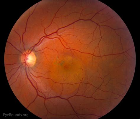 Serous Retinal Detachment Central Serous Chorioretinopathy By