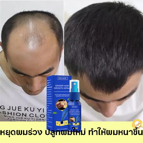 หมดปัญหาผมร่วง Eelhoe น้ำยาปลูกผม 30ml เร่งการงอกใหม่ ป้องกันไม่ให้ขิงหลุด รากผมแข็งแรง ดูแลหนัง