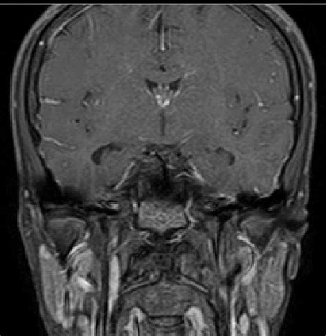 Colloid Cyst Of Third Ventricle Missed On Mri Sumers Radiology Blog