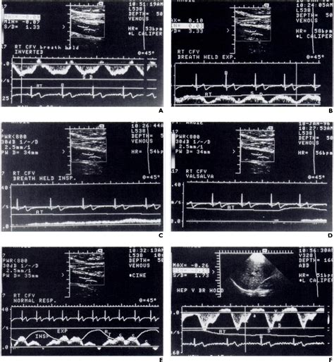 Pdf Normal Lower Limb Venous Doppler Flow Phasicity Is It Cardiac Or