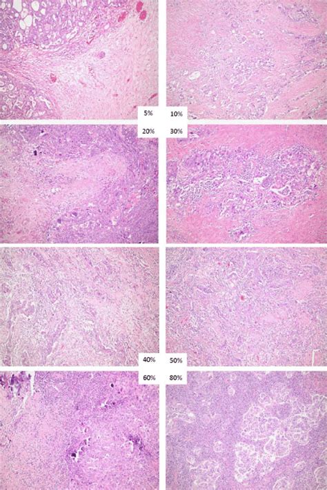 Examples Of A Range Of Stromal Tumor Infiltrating Lymphocytes Download Scientific Diagram