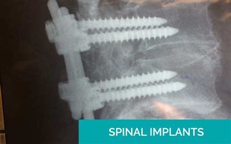 Spinal Implants And Hardware For Spinal Surgery