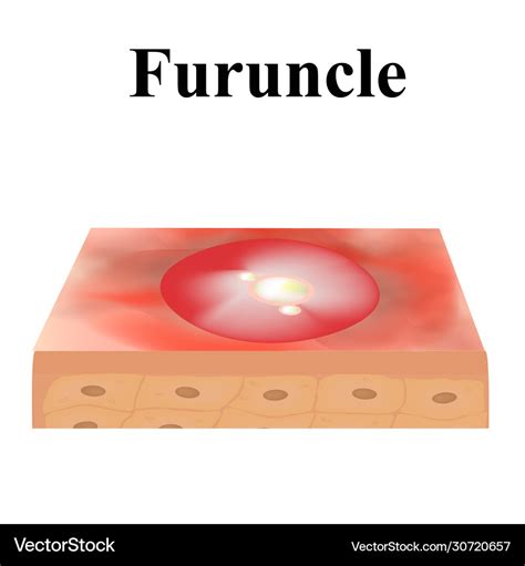 Furuncle Diagram