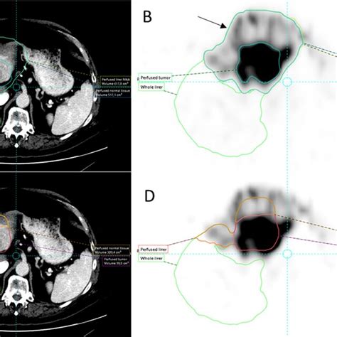 Threshold Based Segmentation Of The Tumour On Spect Panels A And B Is Download Scientific