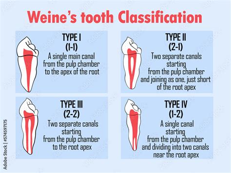 Weines Classification Of Root Canal Morphology From Type I To Type Iv