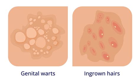 Early Signs And Symptoms Of Genital Warts Zava Uk