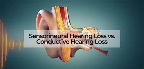 Sensorineural Hearing Loss Vs Conductive Hearing Loss Hearing Solutions