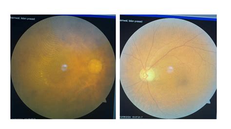 Neovascular Glaucoma Pptx Pptx