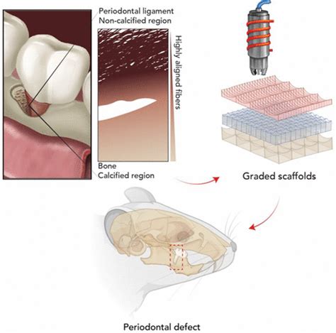 Composite Graded Melt Electrowritten Scaffolds For Regeneration Of The Periodontal Ligament To
