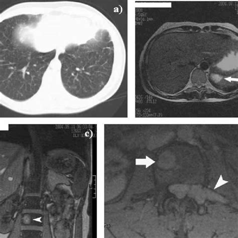A Computed Tomography Scan Of The Chest Shows Multiple Bilateral Download Scientific Diagram