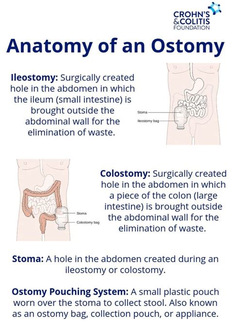 anatomy of an ostomy ostomy life ostomy ostomy care