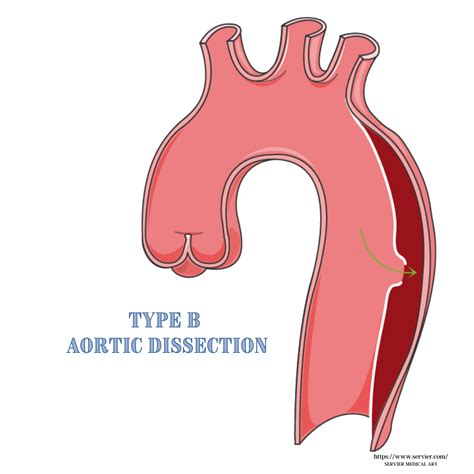 aortic dissection vascular info