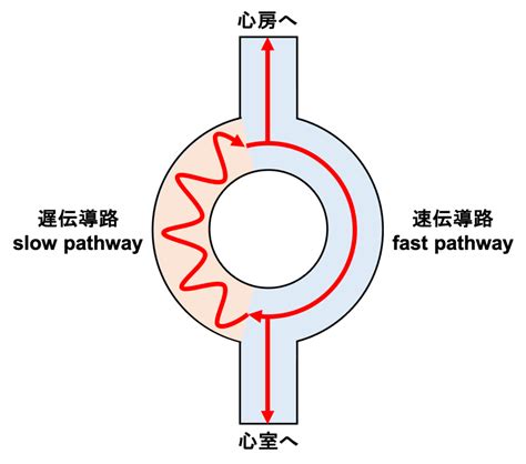 Fast Slow Avnrtとは？ 心電図com