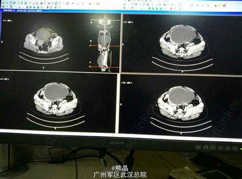 卵巢粘液性囊腺瘤1例 医联