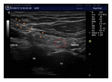 Injection Into The Inguinal Canal To Block The Genitofemoral Nerve Download Scientific Diagram
