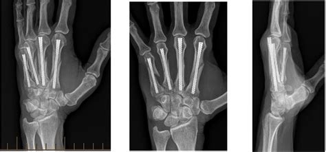 Use Of The Nx Nail For Percutaneous Reduction And Internal Fixation Of Left 2nd 3rd 4th And