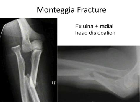Fractures Flashcards Quizlet
