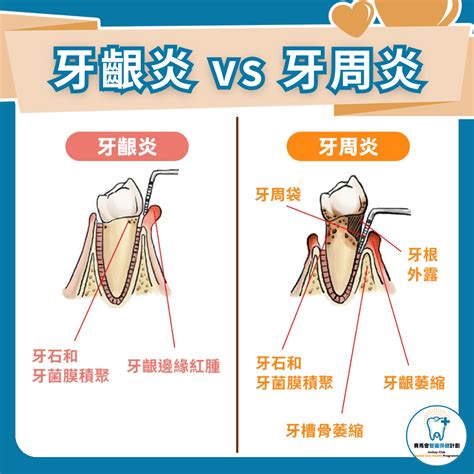 牙周病是什麼？患上牙周病怎麼辦，認識牙周病的3大治療方法 賽馬會智齒保健計劃