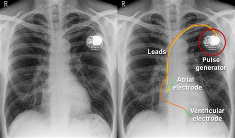 Ai Can Improve Xray Identification Of Pacemakers In