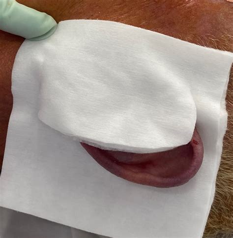 Post Auricular Dressings Dr Sean Flanagan