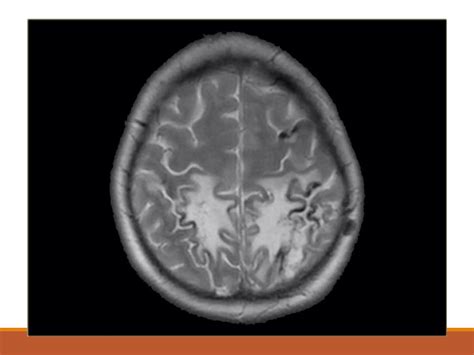 Imaging In Cerebral Venous Thrombosis Ppt