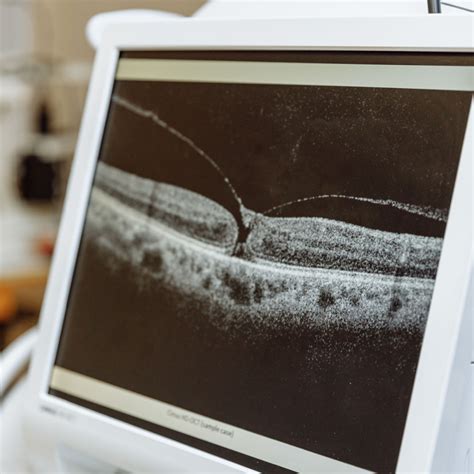 What Is An OCT Scan Opticare Opticians Scotland