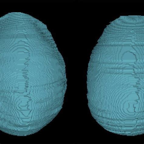 Cta Based 3d Perforator Mapping In Diep Flap Planning Performed Using Download Scientific