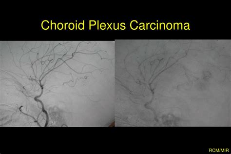 PPT Choroid Plexus Carcinoma PowerPoint Presentation Free Download ID 5140016