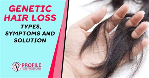 Genetic Hair Loss Types Symptoms And Treatment