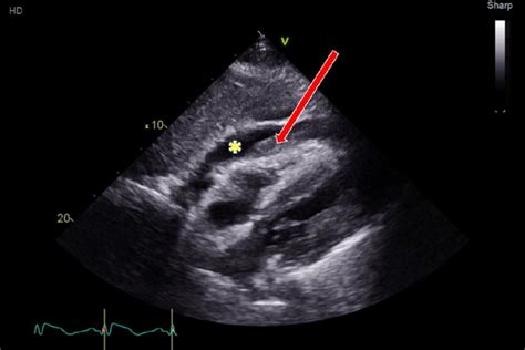 Pericardial Effusion Ultrasound