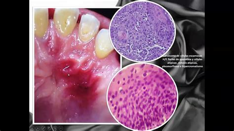 Eritroplasia Oral Youtube