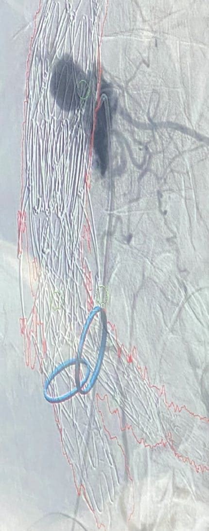 How I Do It Management Of Type Ii Endoleak With A Transcaval Approach Endovascular Today