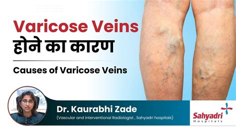 Understanding The Causes Of Varicose Veins