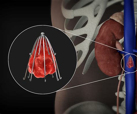 Ivc Filter Heart Center Ranchi