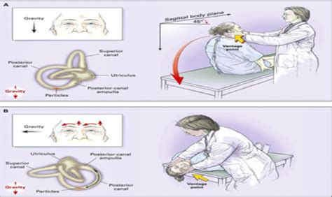 Bppv Flashcards Quizlet