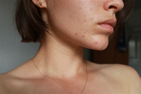 Hormonal Acne Treatment Causes And Prevention Trackyourmax
