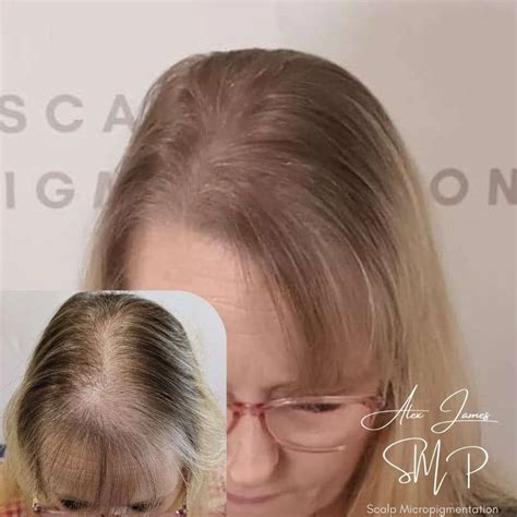 Thinning Hair Smp Manchester Hair Density Treatment