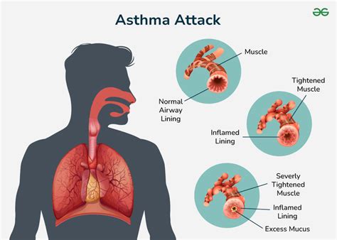Asthma Geeksforgeeks