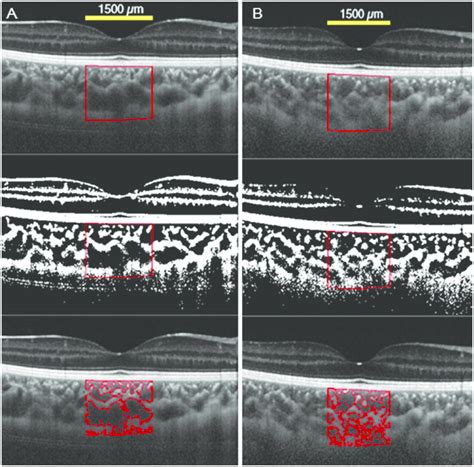 Enhanced Depth Spectral Domain Optical Coherence Tomographic Edi Oct