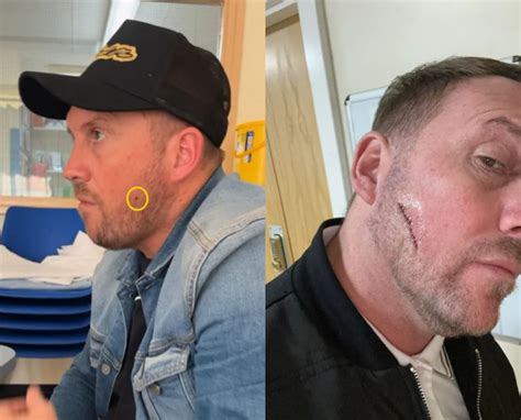 뺨에 난 반점 여드름 아닌 암이었다이 행동 자주 해서