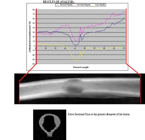Ct Based Structural Rigidity Analysis Ctra In This Femoral Lesion Download Scientific