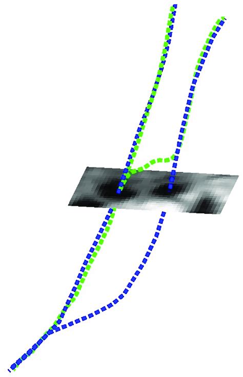 Centerline Detection At The Carotid Artery By Finding Two Independent