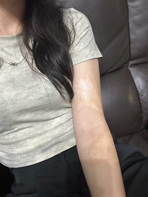 很小的時候燙傷的傷疤 以前每當被問到就會難過 覺得自己的手是不是很奇怪 身邊家人也會一直希望我長大後去做手術 但隨著它陪伴我越來越久之後 好像