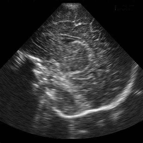 Caudothalamic Groove Anatomy At Beverly Kiker Blog