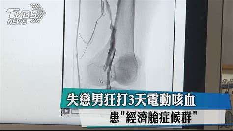 失戀男狂打3天電動咳血 患「經濟艙症候群」 Youtube