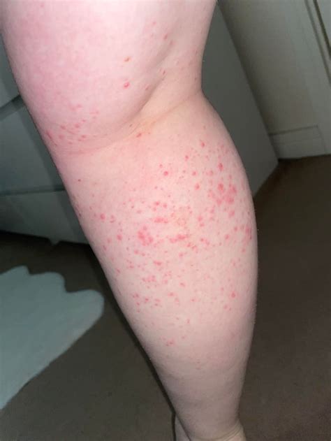 Leg Rash R Leicester
